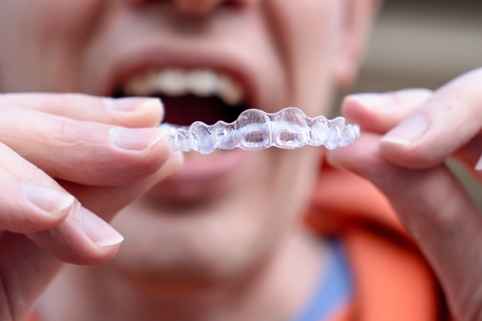 Why Adults Choose Invisalign in Fitchburg
